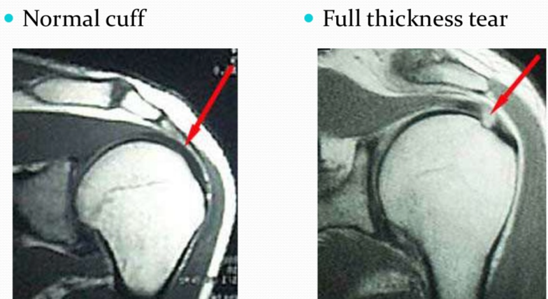 Rotator Cuff and Night Pain: What to Do? - Dr Marouane Bouloudhnine