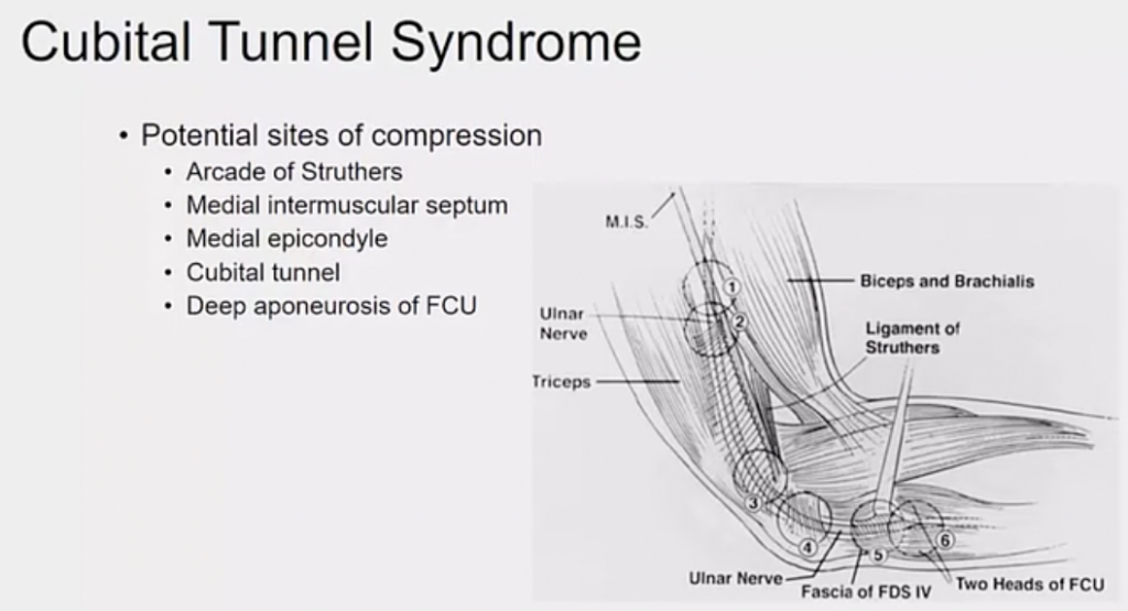 Ulnar Nerve Compression at the Elbow - Dr Marouane Bouloudhnine