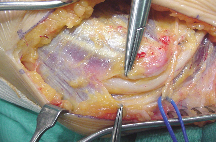 Ulnar Nerve Compression at the Elbow - Dr Marouane Bouloudhnine