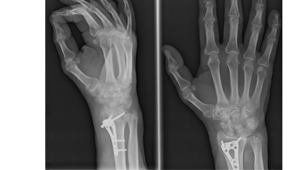 Understanding Radius Fractures: Causes, Symptoms, and Treatment - Dr ...