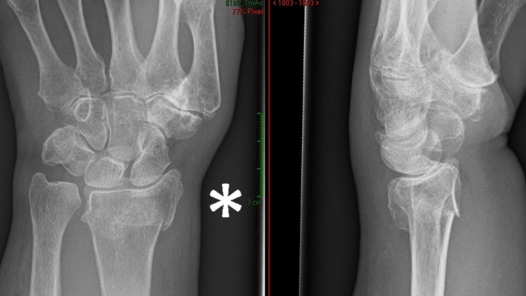 Understanding Radius Fractures: Causes, Symptoms, and Treatment - Dr ...
