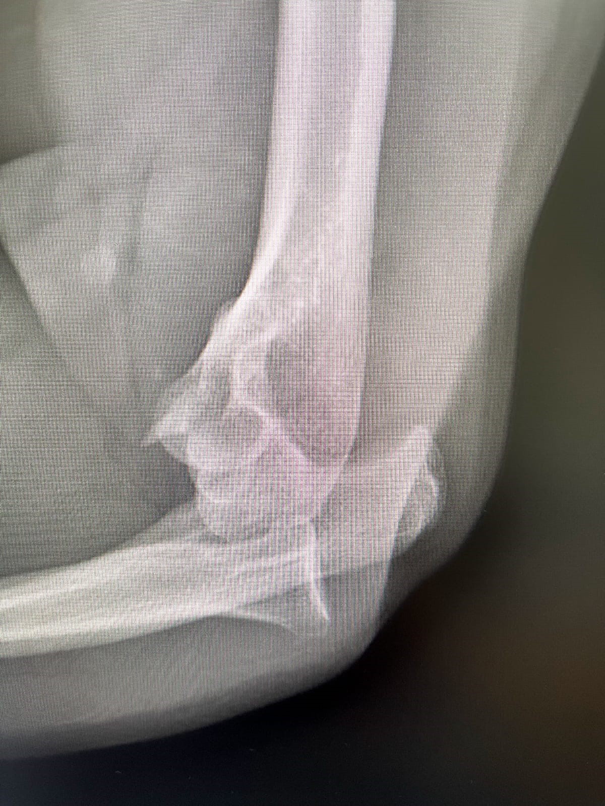 10 Frequent Causes of Chronic Elbow Pain & When to Seek Help - Dr ...