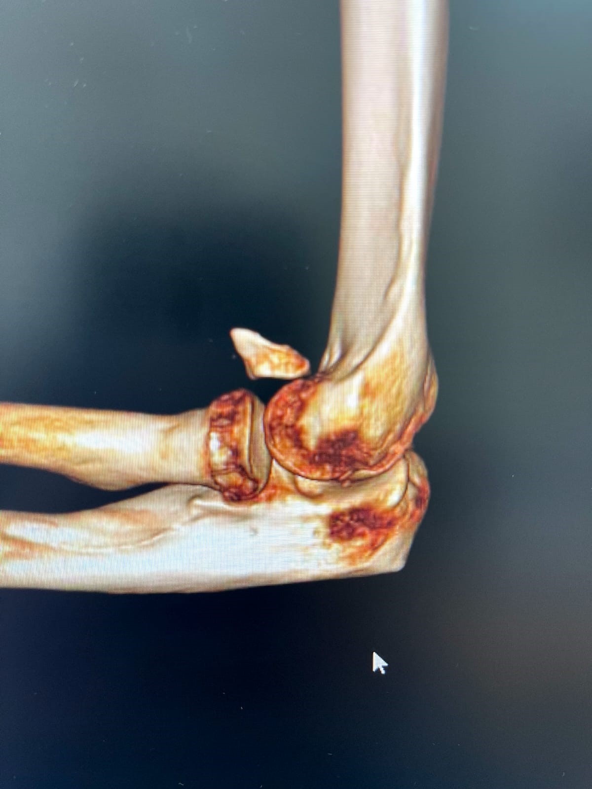 10 Frequent Causes of Chronic Elbow Pain & When to Seek Help - Dr ...