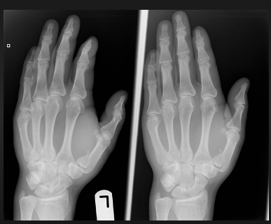 Hand Fractures: Do’s and Don’ts During the Healing Process