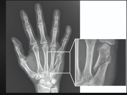 Hand Fractures: Do’s and Don’ts During the Healing Process