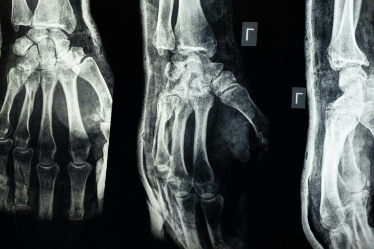Sprained Wrist vs Broken Wrist: How to Tell the Difference - Dr ...