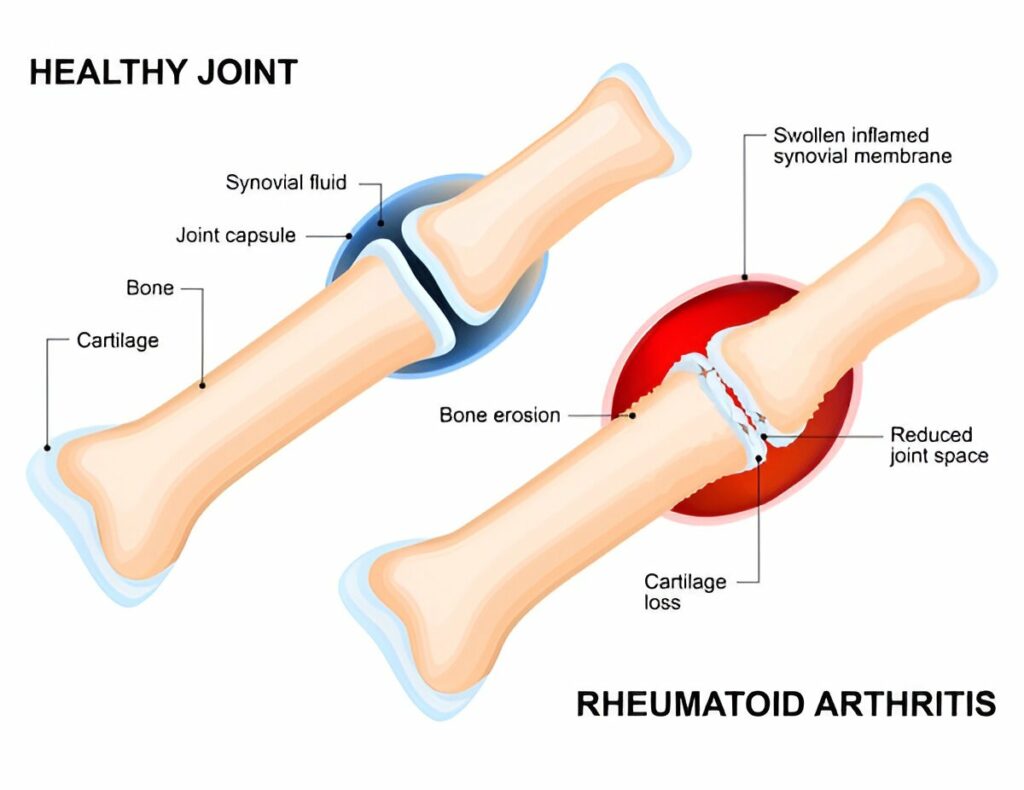 Treatments for Rheumatoid Arthritis Hand Deformities