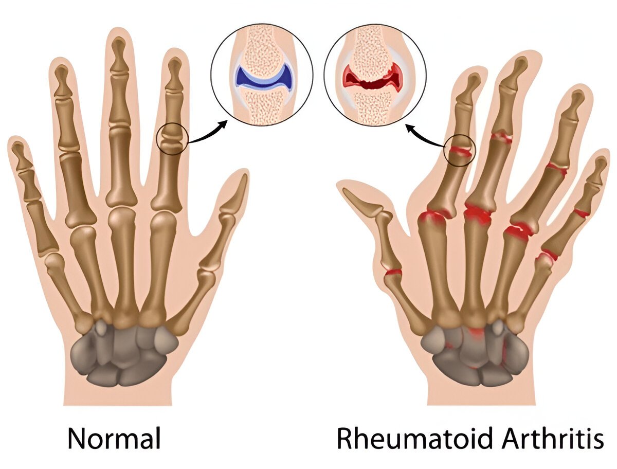 Treatments for Rheumatoid Arthritis Hand Deformities